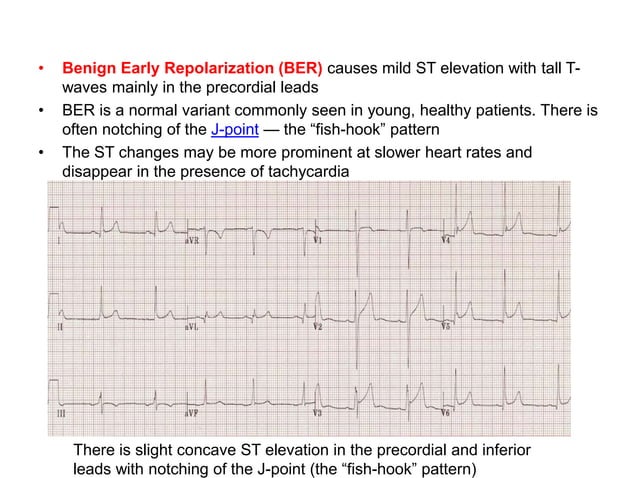 ST SEGMENT IN ECG,ST ELEVATION AND ST DEPRESSION | PPTX