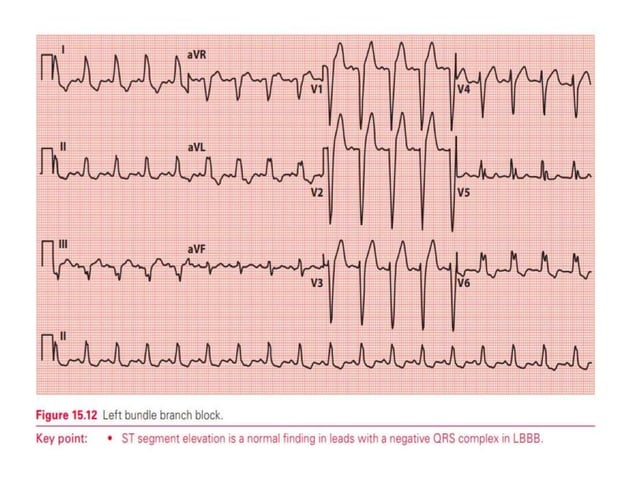 ST SEGMENT IN ECG,ST ELEVATION AND ST DEPRESSION | PPTX