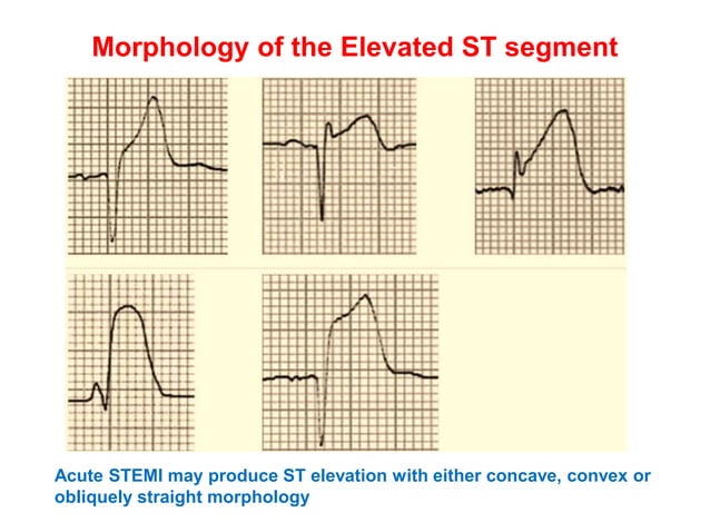 ST SEGMENT IN ECG,ST ELEVATION AND ST DEPRESSION | PPTX