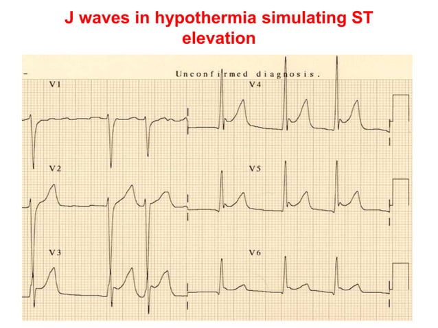 ST SEGMENT IN ECG,ST ELEVATION AND ST DEPRESSION | PPTX