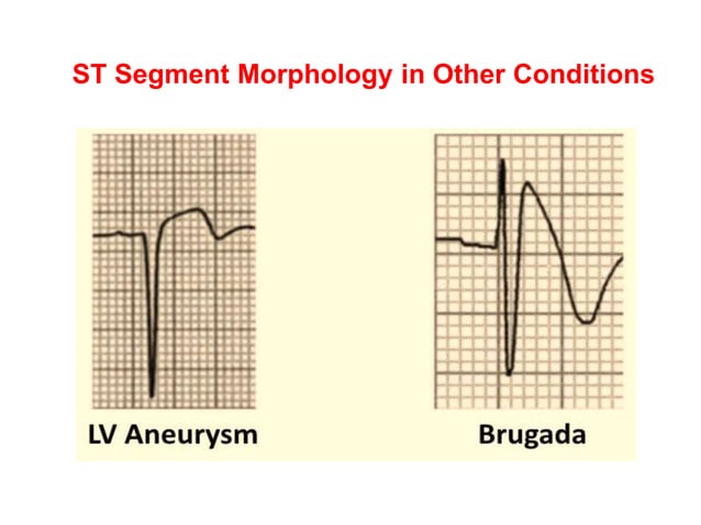 ST SEGMENT IN ECG,ST ELEVATION AND ST DEPRESSION | PPTX