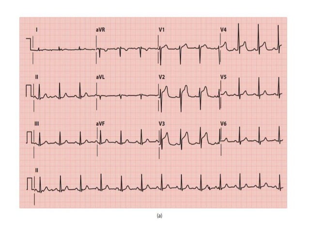 ST SEGMENT IN ECG,ST ELEVATION AND ST DEPRESSION | PPTX