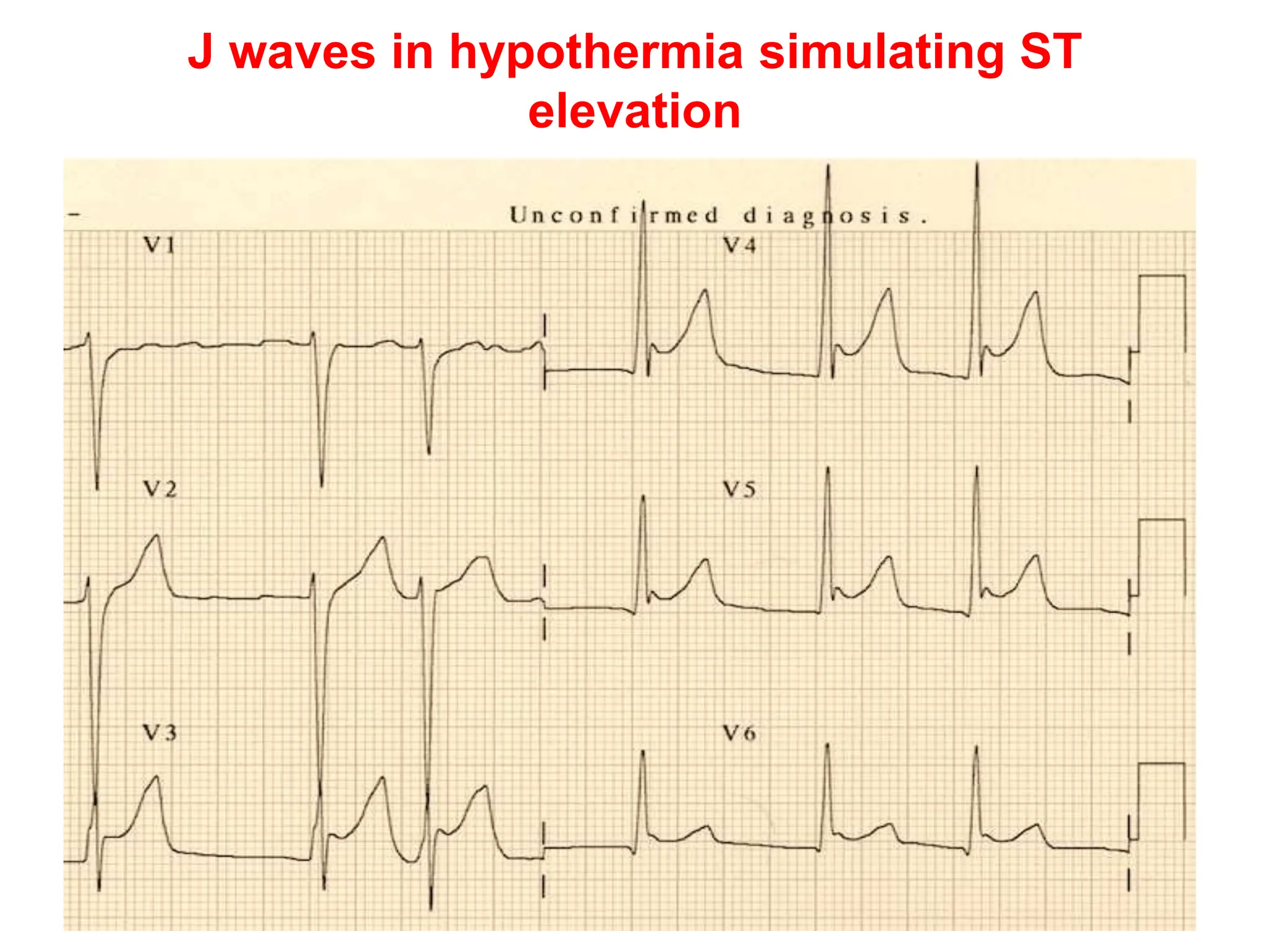 ST SEGMENT IN ECG,ST ELEVATION AND ST DEPRESSION | PPTX