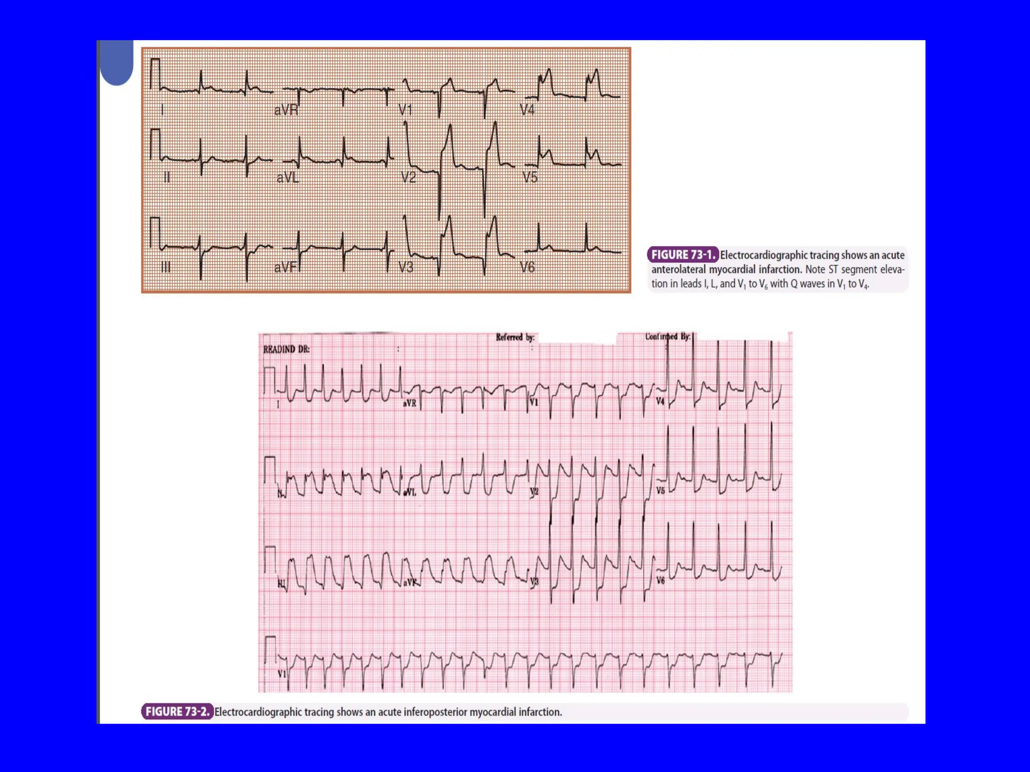 St Segment Elevation Acute Myocardial Infarction And Complications Of Myocardial Infarction