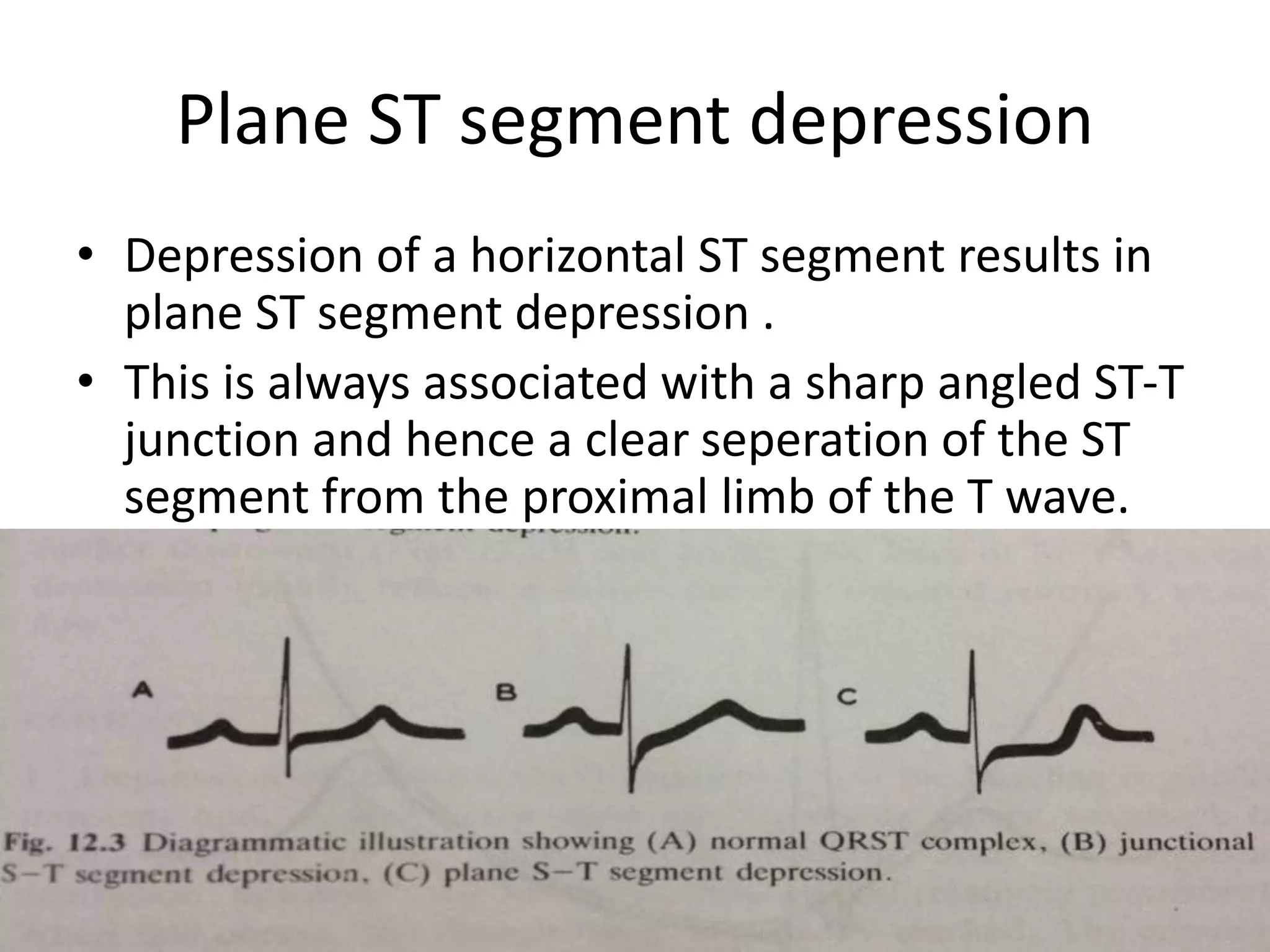 St segment elevations | PPTX