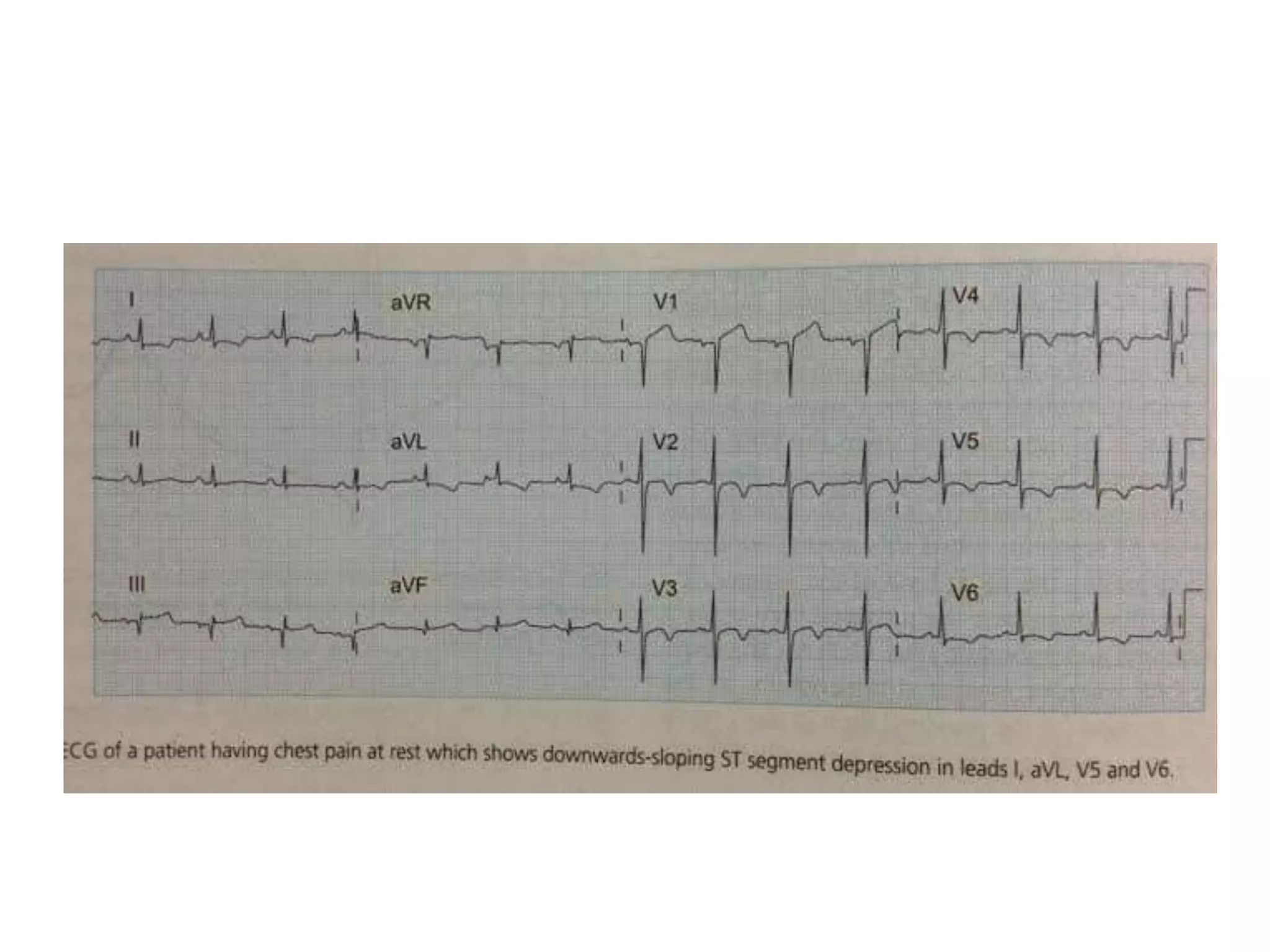 St segment elevations | PPTX