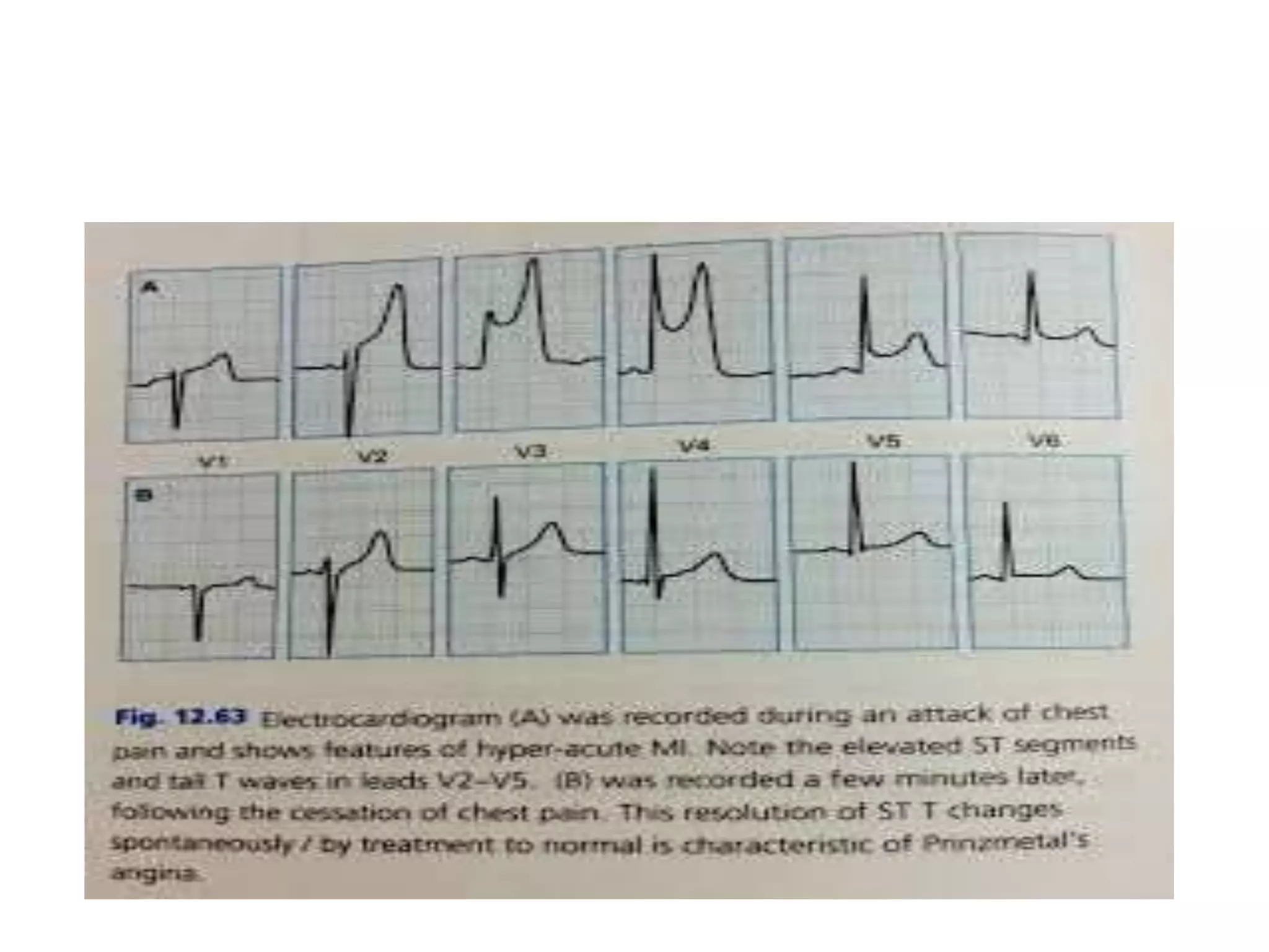 St segment elevations | PPTX