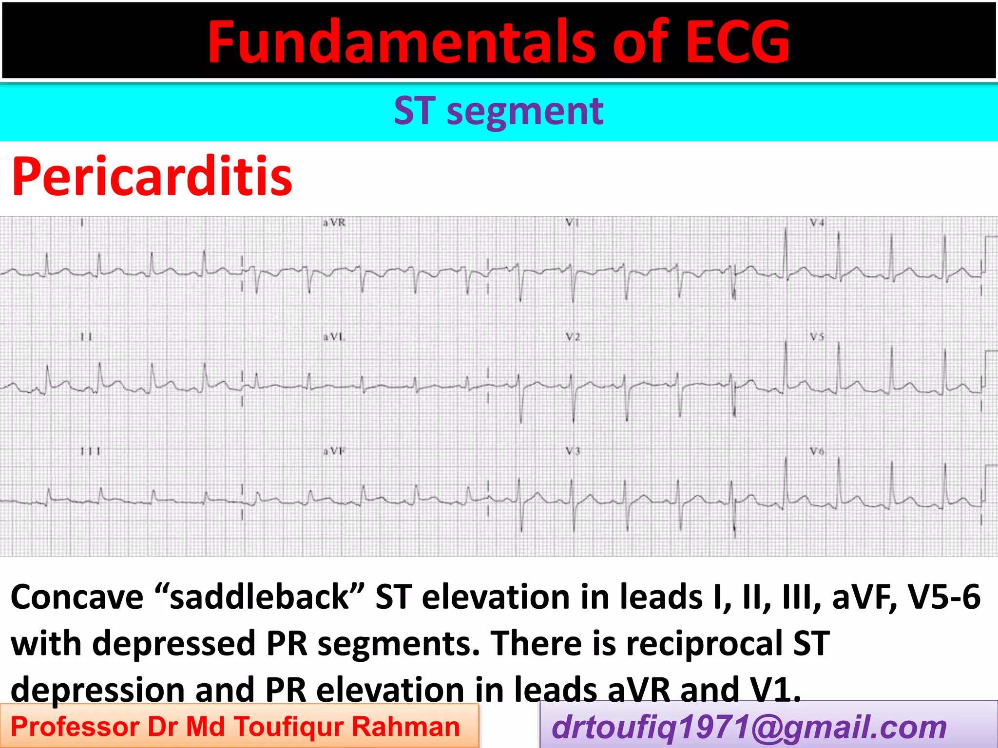 Approach to a patient with ST segment abnormality in ECG | PPT
