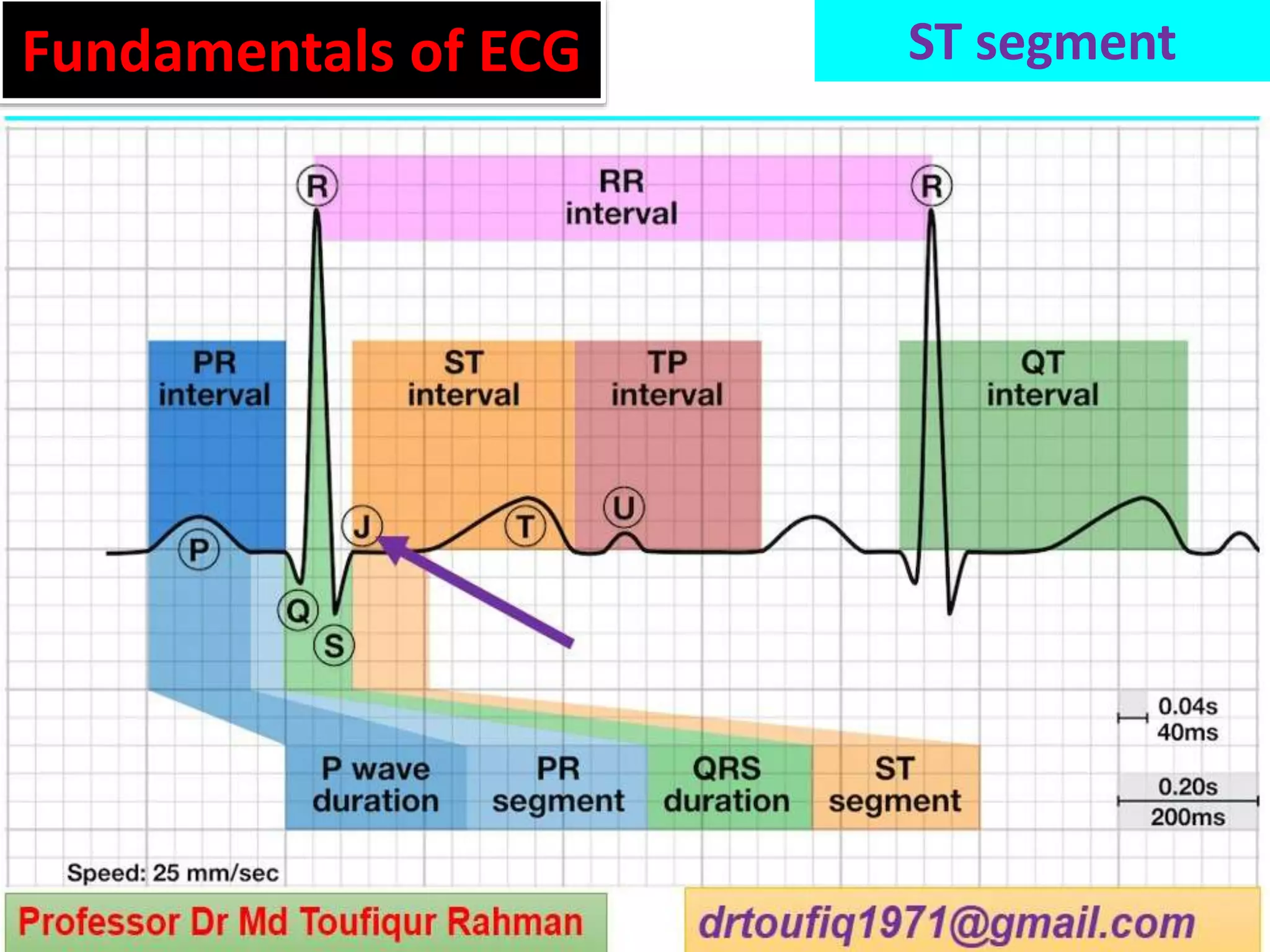 Approach to a patient with ST segment abnormality in ECG | PPT