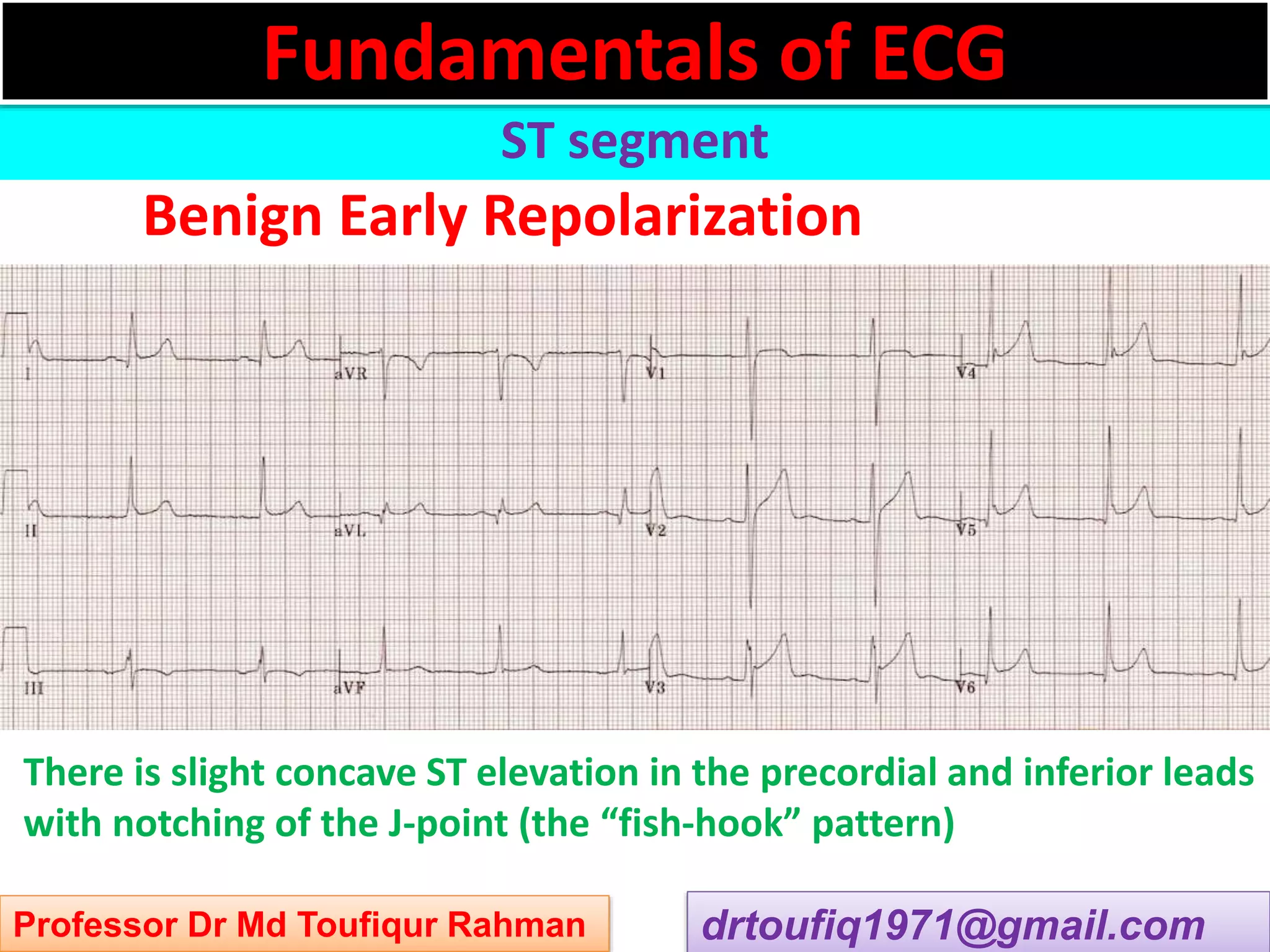 Approach to a patient with ST segment abnormality in ECG | PPT