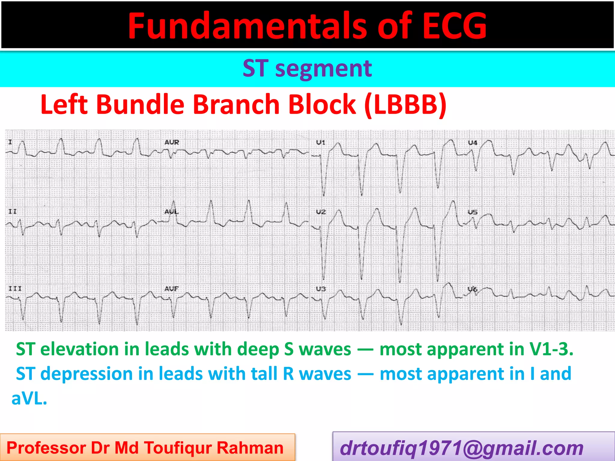 Approach to a patient with ST segment abnormality in ECG | PPT