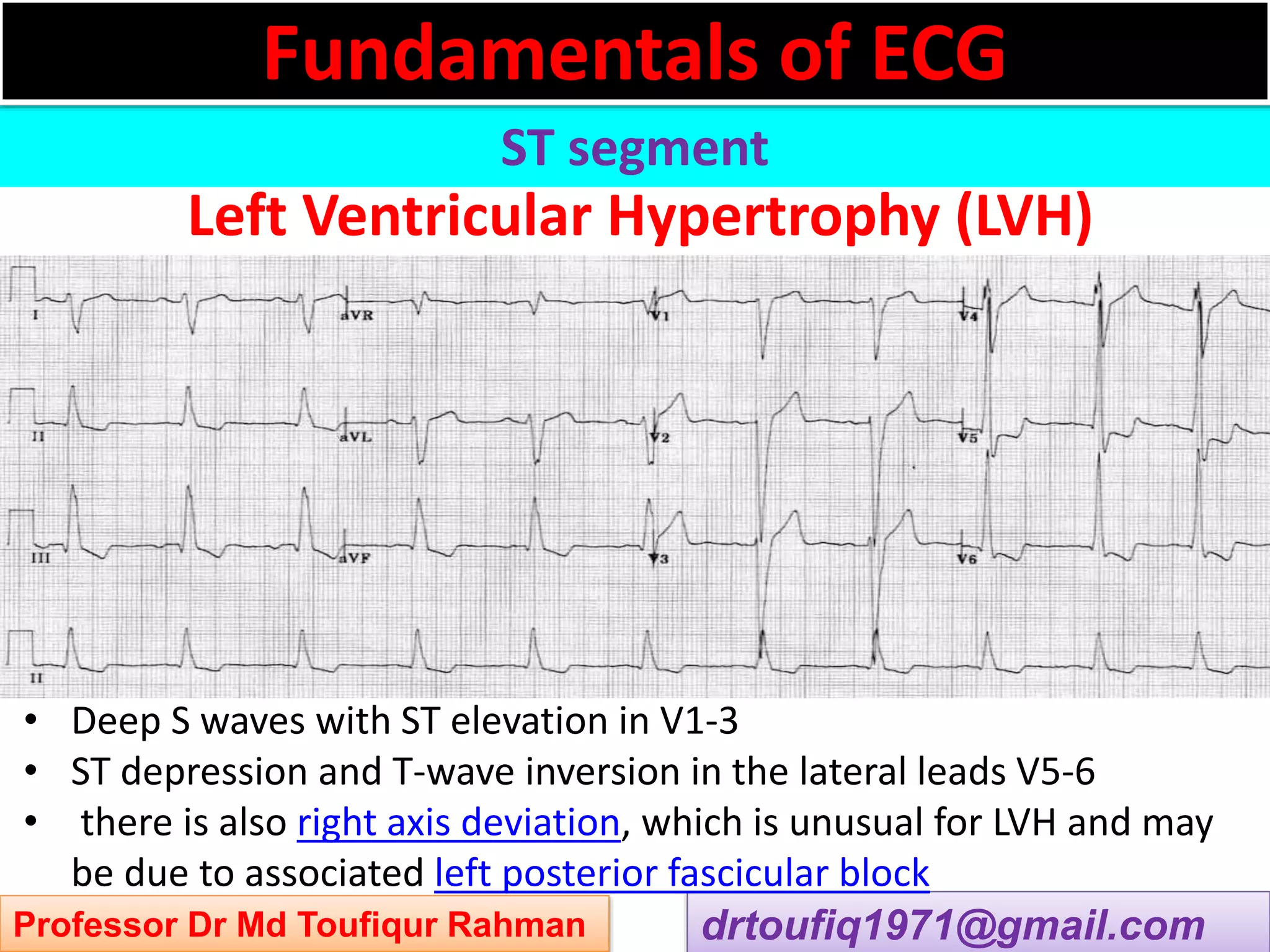 Approach to a patient with ST segment abnormality in ECG | PPT
