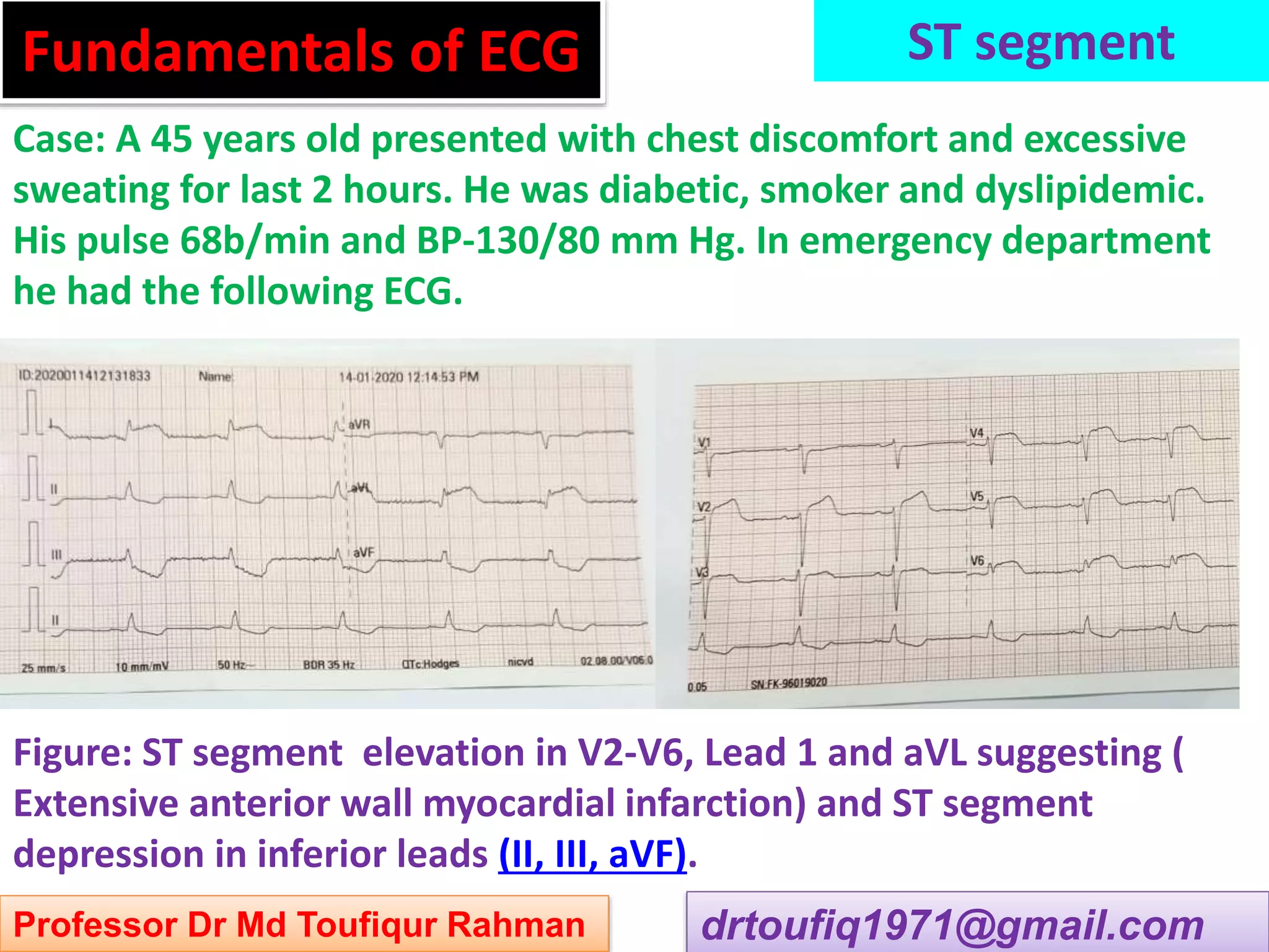 Approach to a patient with ST segment abnormality in ECG | PPT