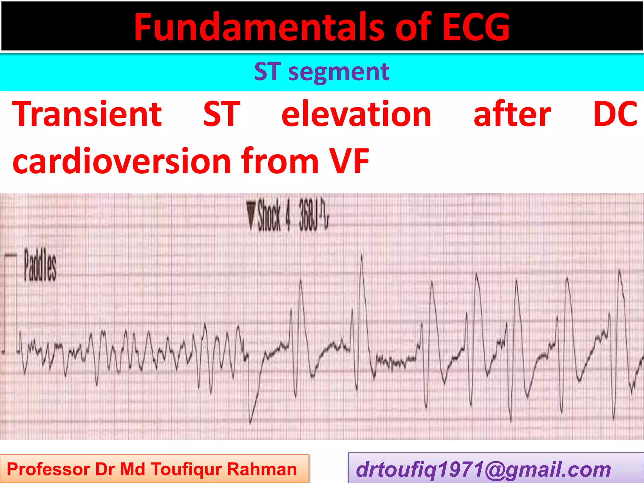 Approach to a patient with ST segment abnormality in ECG | PPT