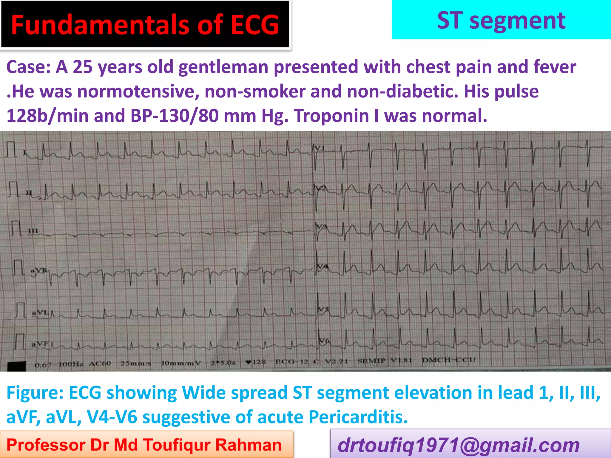 Approach to a patient with ST segment abnormality in ECG | PPT