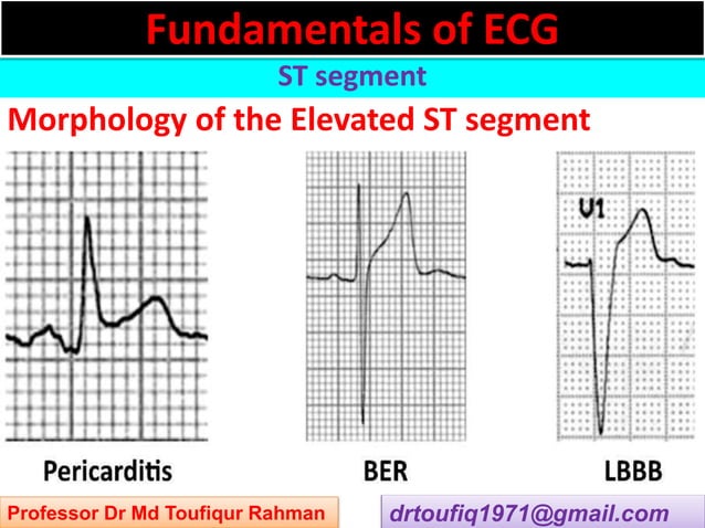 Approach to a patient with ST segment abnormality in ECG | PPT