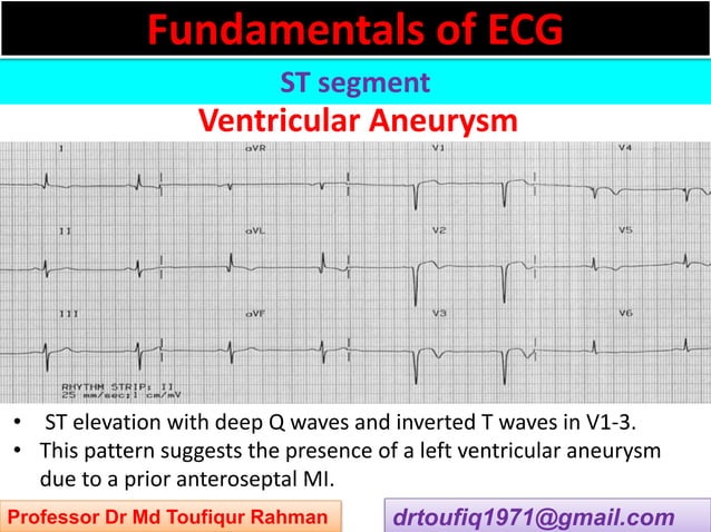 Approach to a patient with ST segment abnormality in ECG | PPT