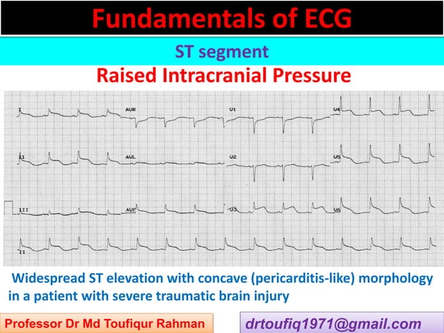 Approach to a patient with ST segment abnormality in ECG | PPT
