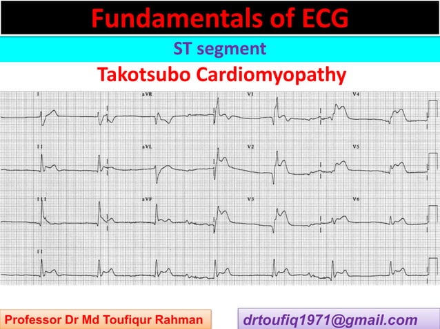 Approach to a patient with ST segment abnormality in ECG | PPT