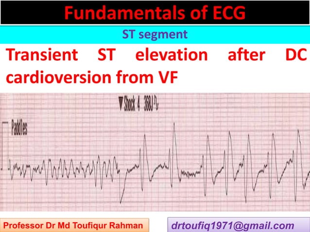 Approach to a patient with ST segment abnormality in ECG | PPT
