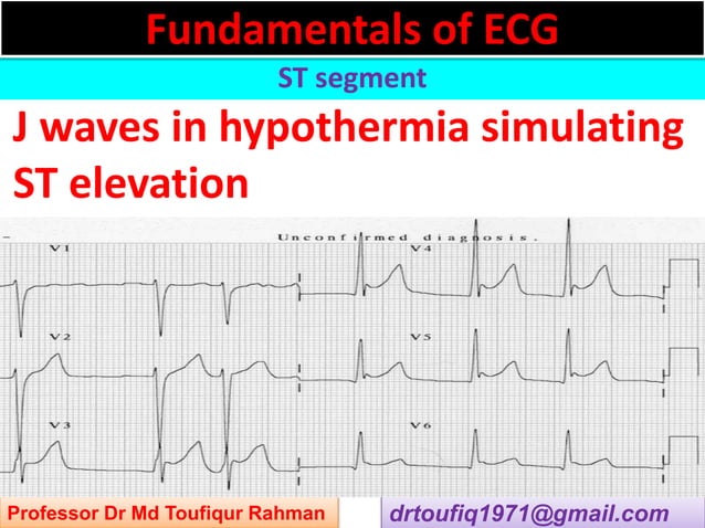 Approach to a patient with ST segment abnormality in ECG | PPT