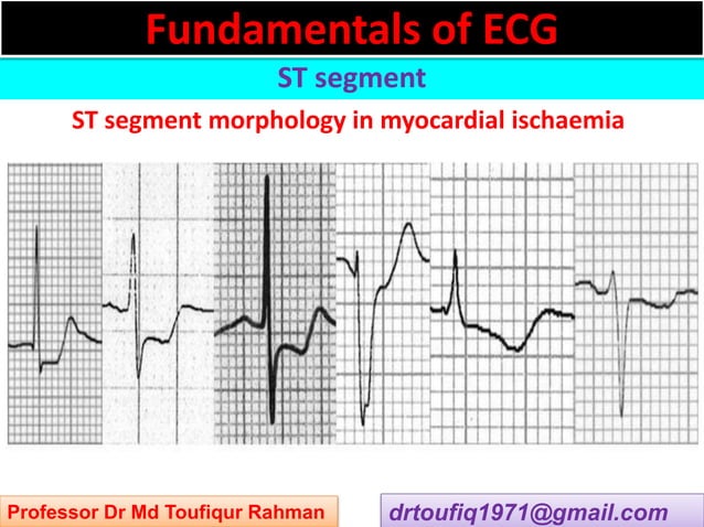 Approach to a patient with ST segment abnormality in ECG | PPT