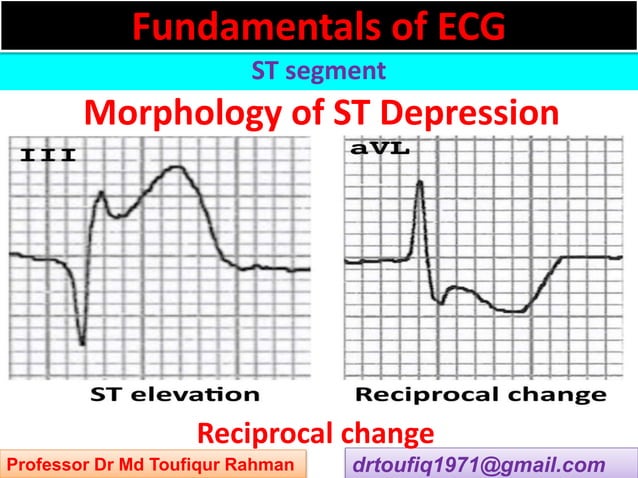 Approach to a patient with ST segment abnormality in ECG | PPT
