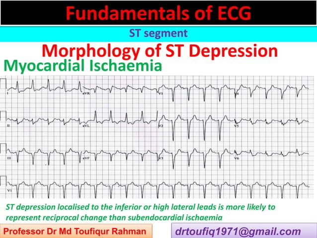 Approach to a patient with ST segment abnormality in ECG | PPT