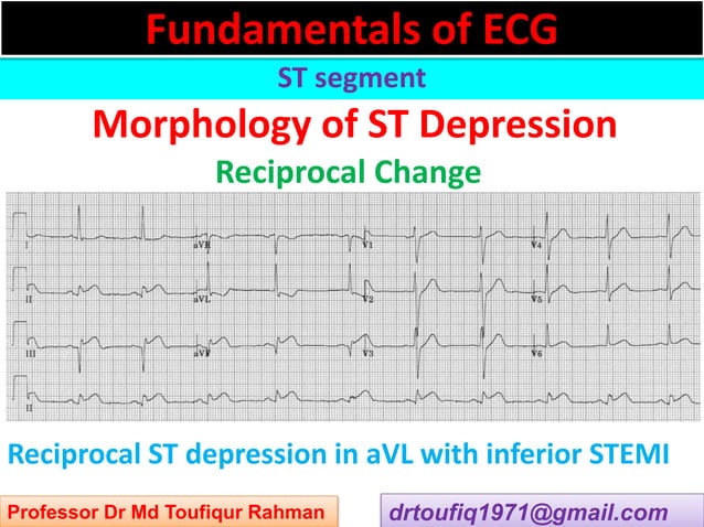 Approach to a patient with ST segment abnormality in ECG | PPT