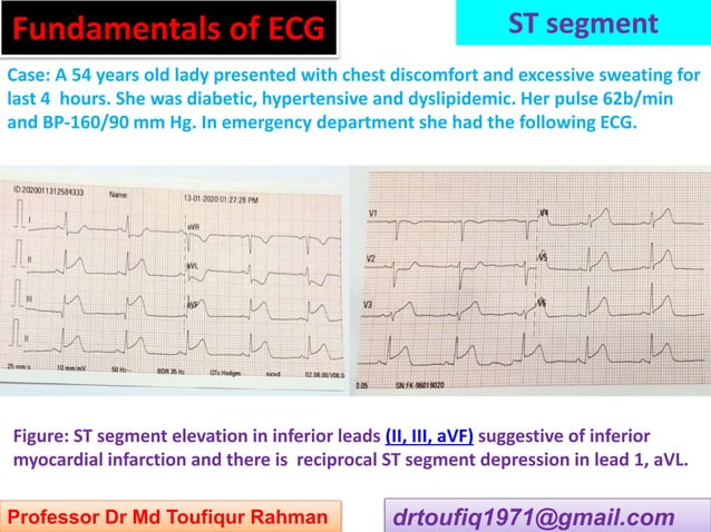 Approach to a patient with ST segment abnormality in ECG | PPT
