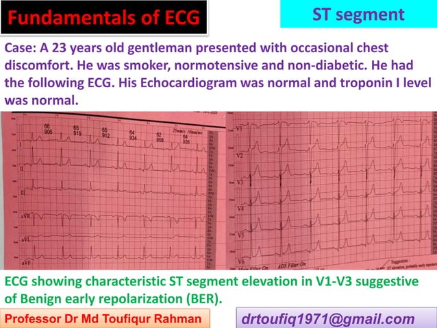 Approach to a patient with ST segment abnormality in ECG | PPT