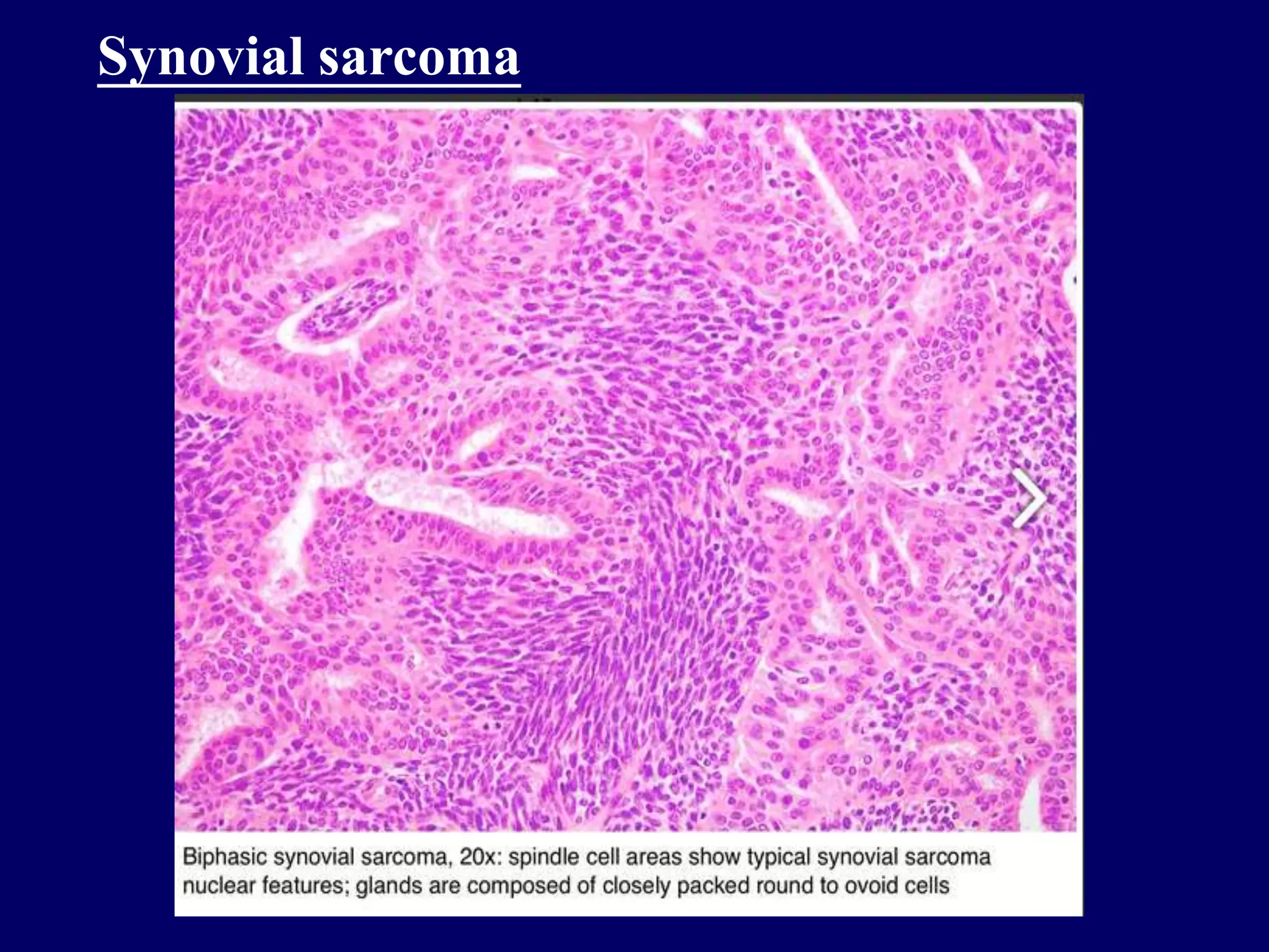 Soft tissue tumor.ppt