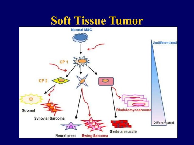 Soft tissue tumor.ppt | Cancer | Diseases and Conditions