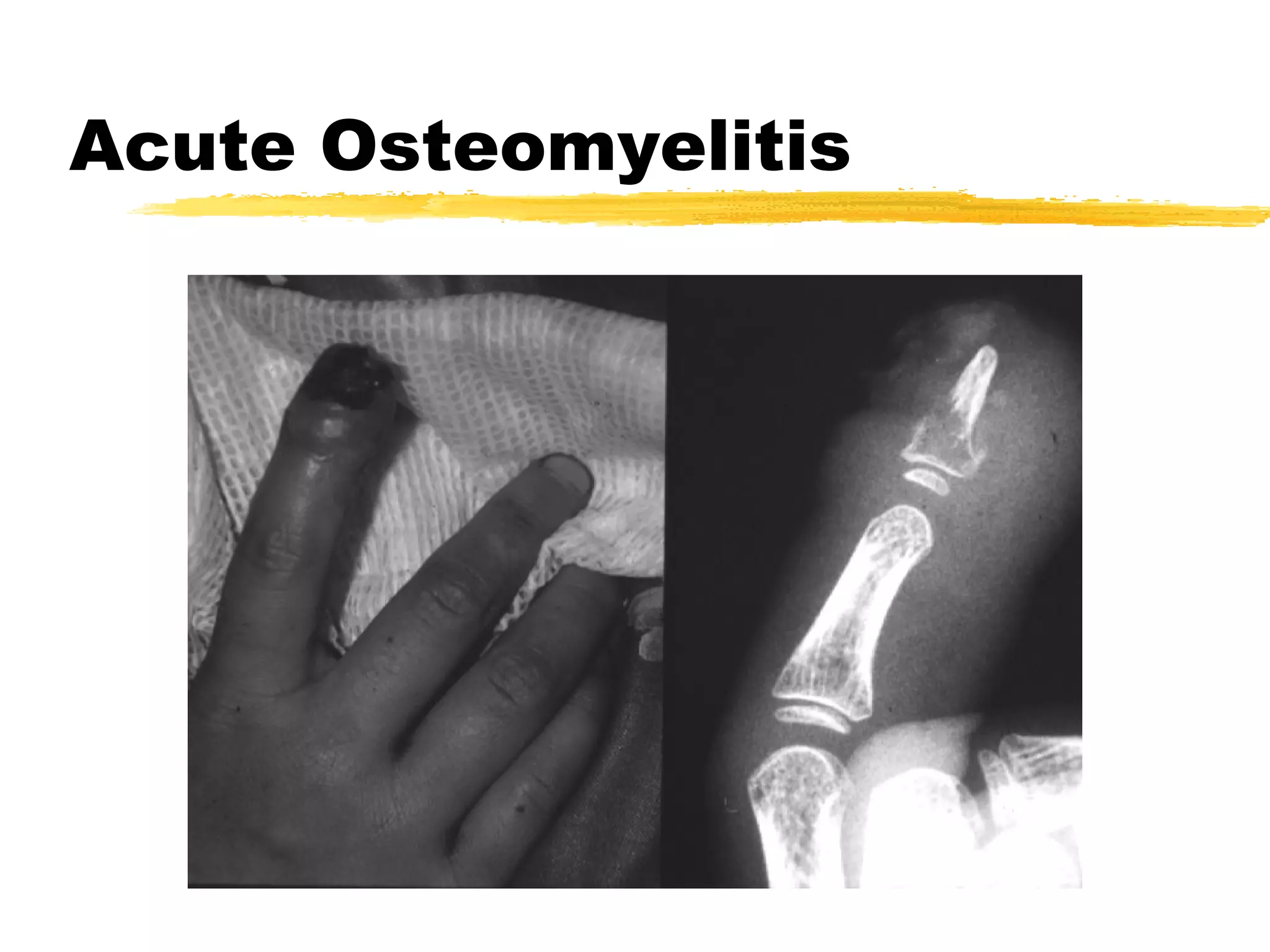 Bone and joint infections- Osteomyelitis | PPT