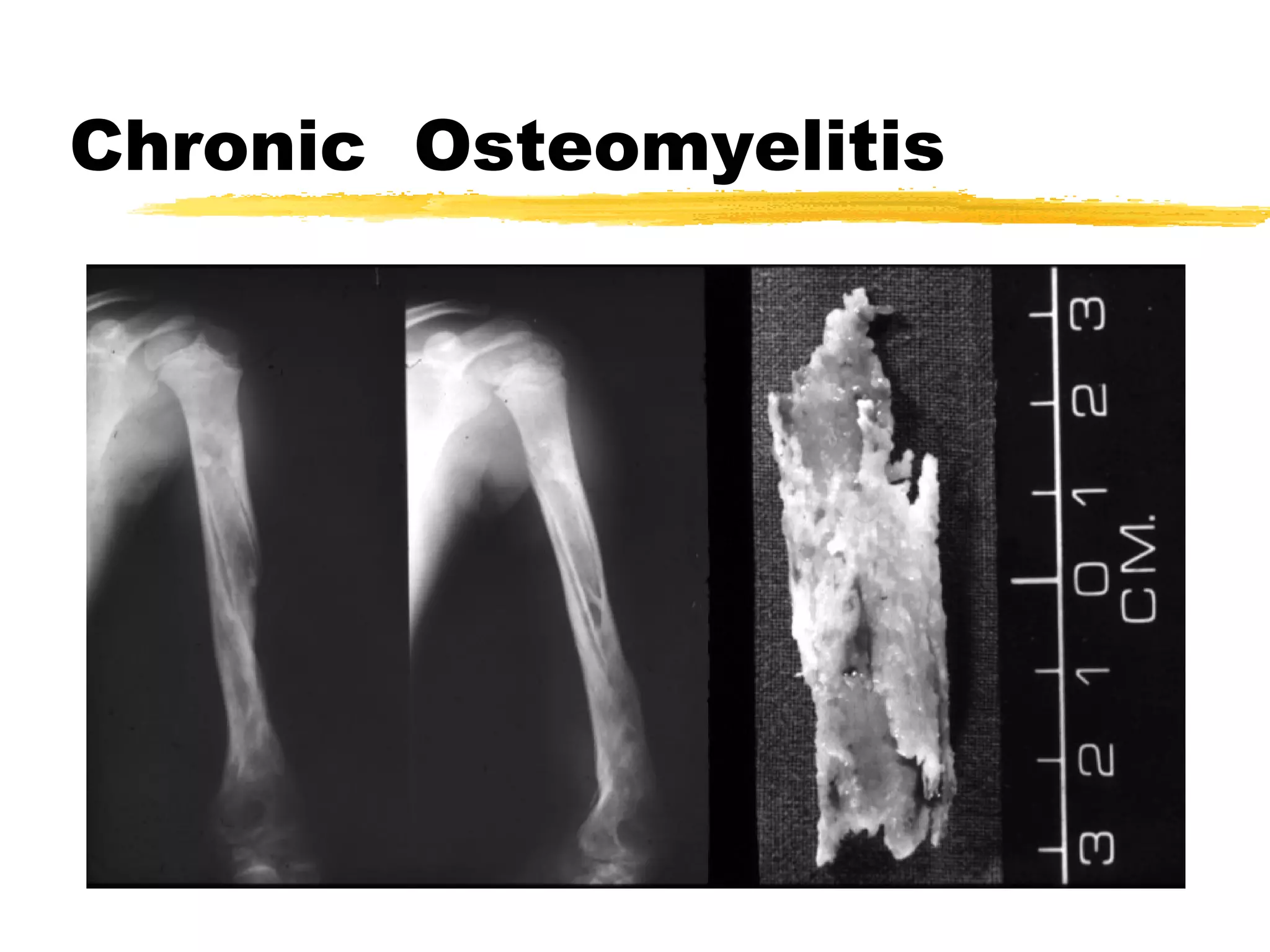 Bone and joint infections- Osteomyelitis | PPT