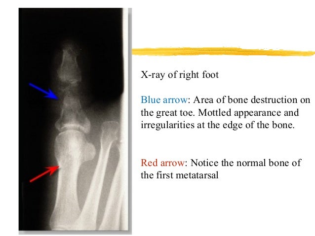 Bone and joint infections- Osteomyelitis