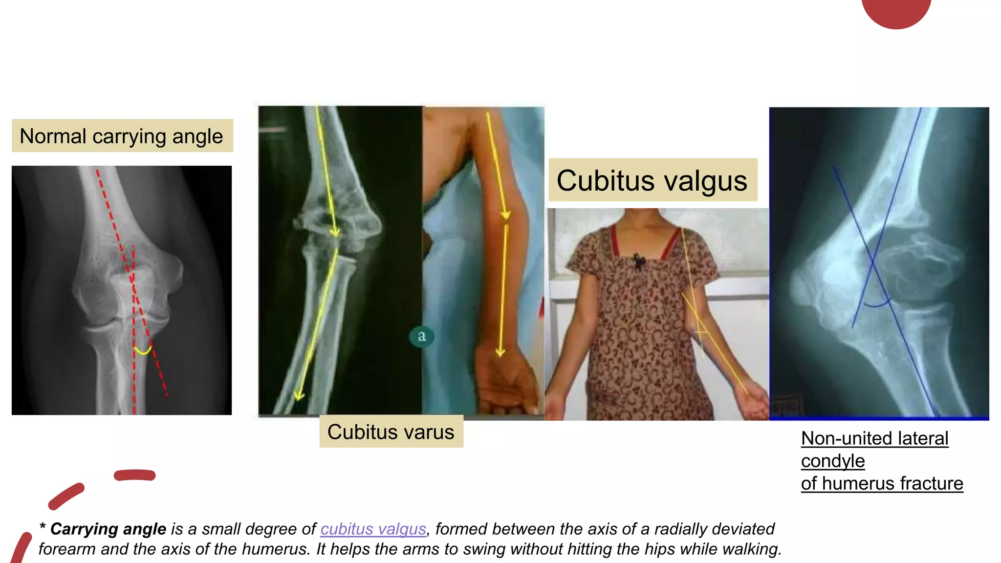 Student Seminar Valgus Varus PPTX Student Seminar Valgus Varus PPTX