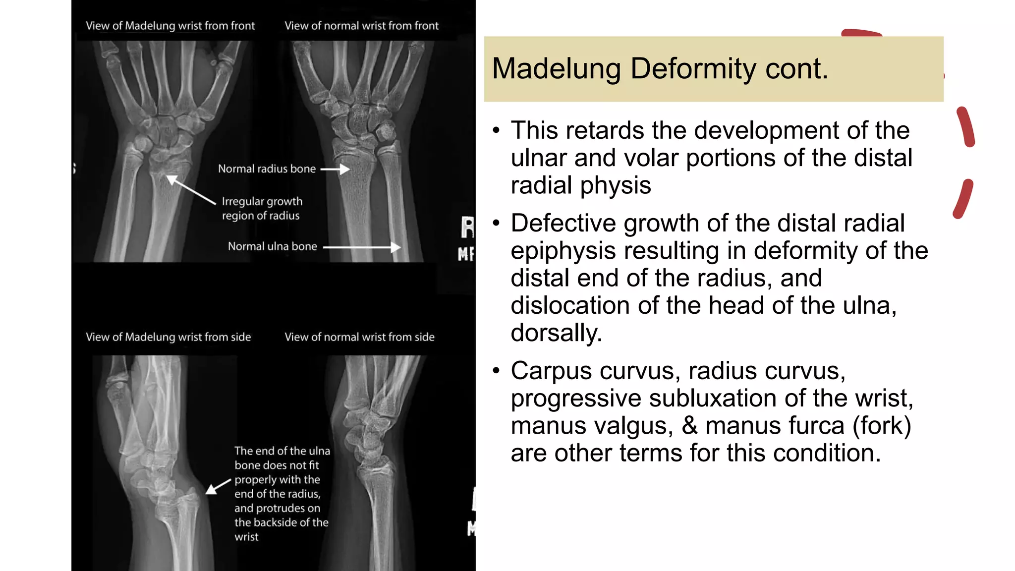 Student seminar valgus & varus | PPTX