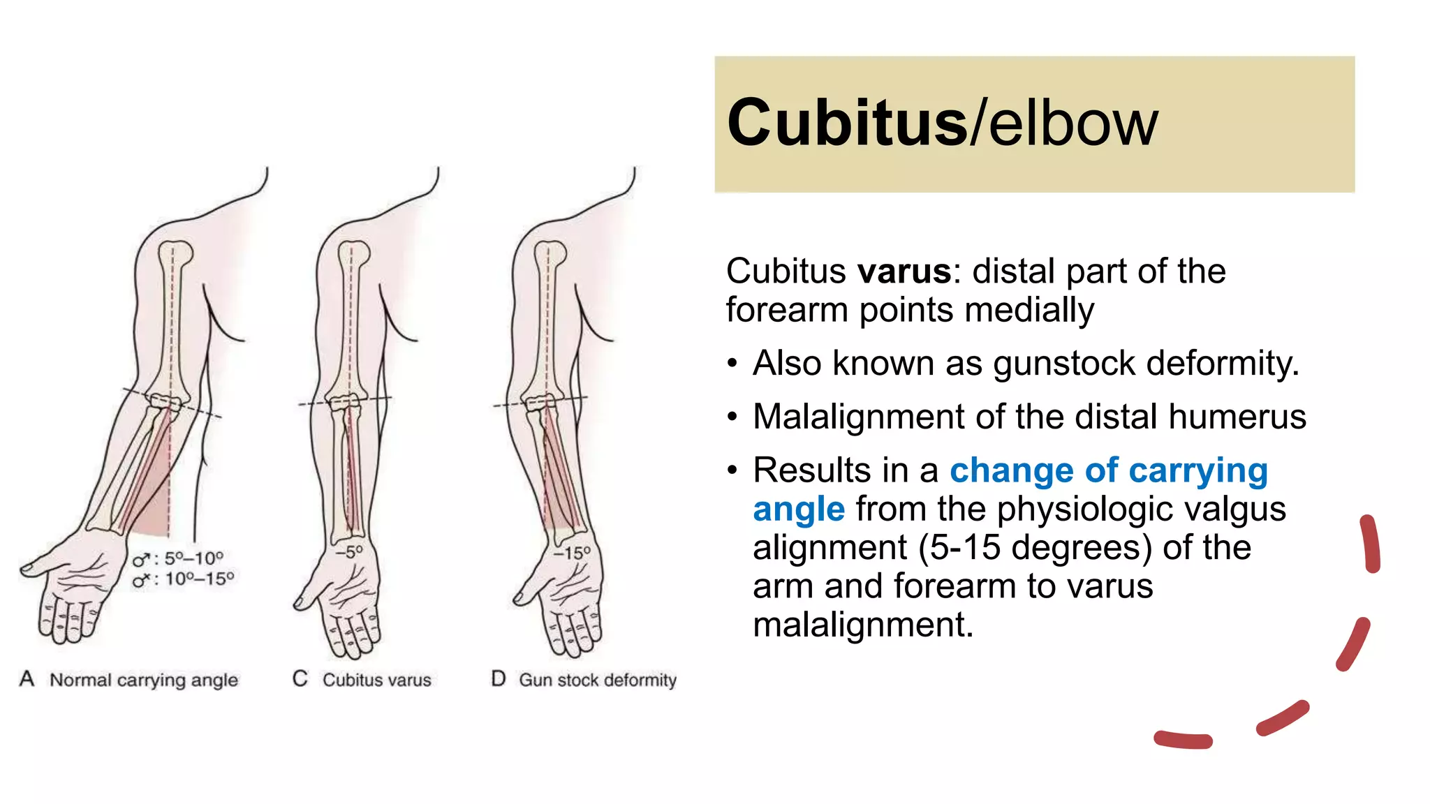 Student seminar valgus & varus | PPTX