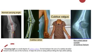 Student seminar valgus & varus | PPTX