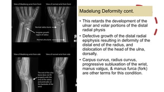 Student seminar valgus & varus | PPTX