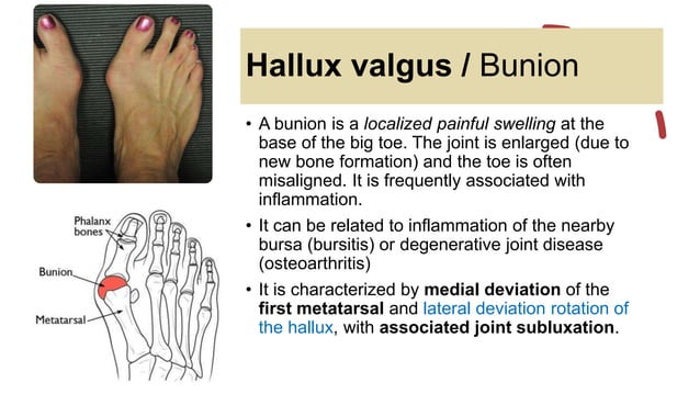 Student seminar valgus & varus | PPTX | Death, Injury, or Military ...
