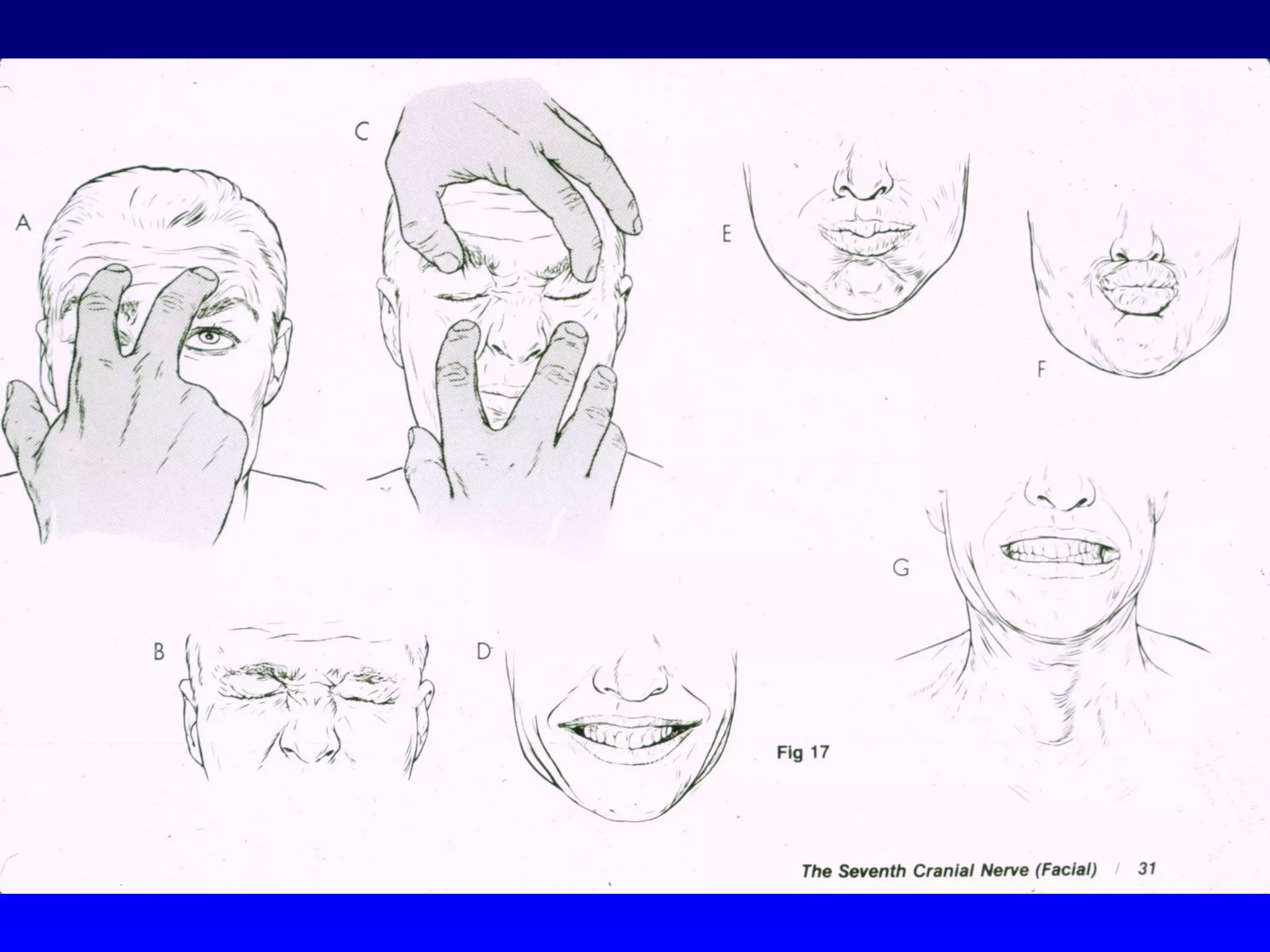 Students Facial Weakness | PPT