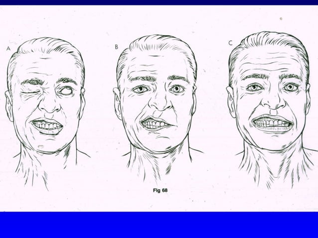 Students Facial Weakness | PPT | Brain and Nervous System Disorders ...