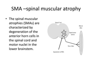 Spinal muscle atrophy SMA: make it easy | PPTX