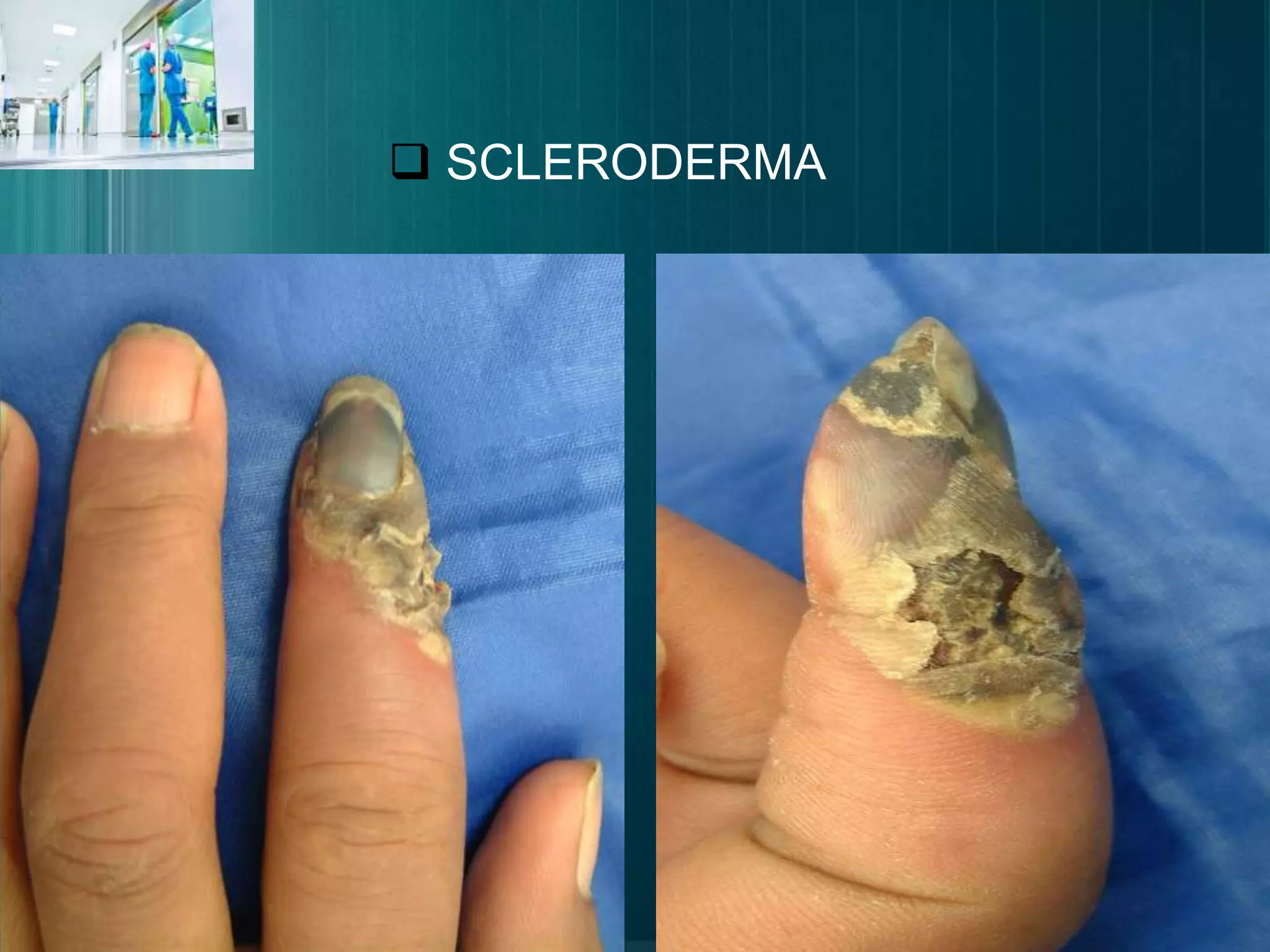 Amputation,Stump care, phantom limb pain and gait training in lower ...