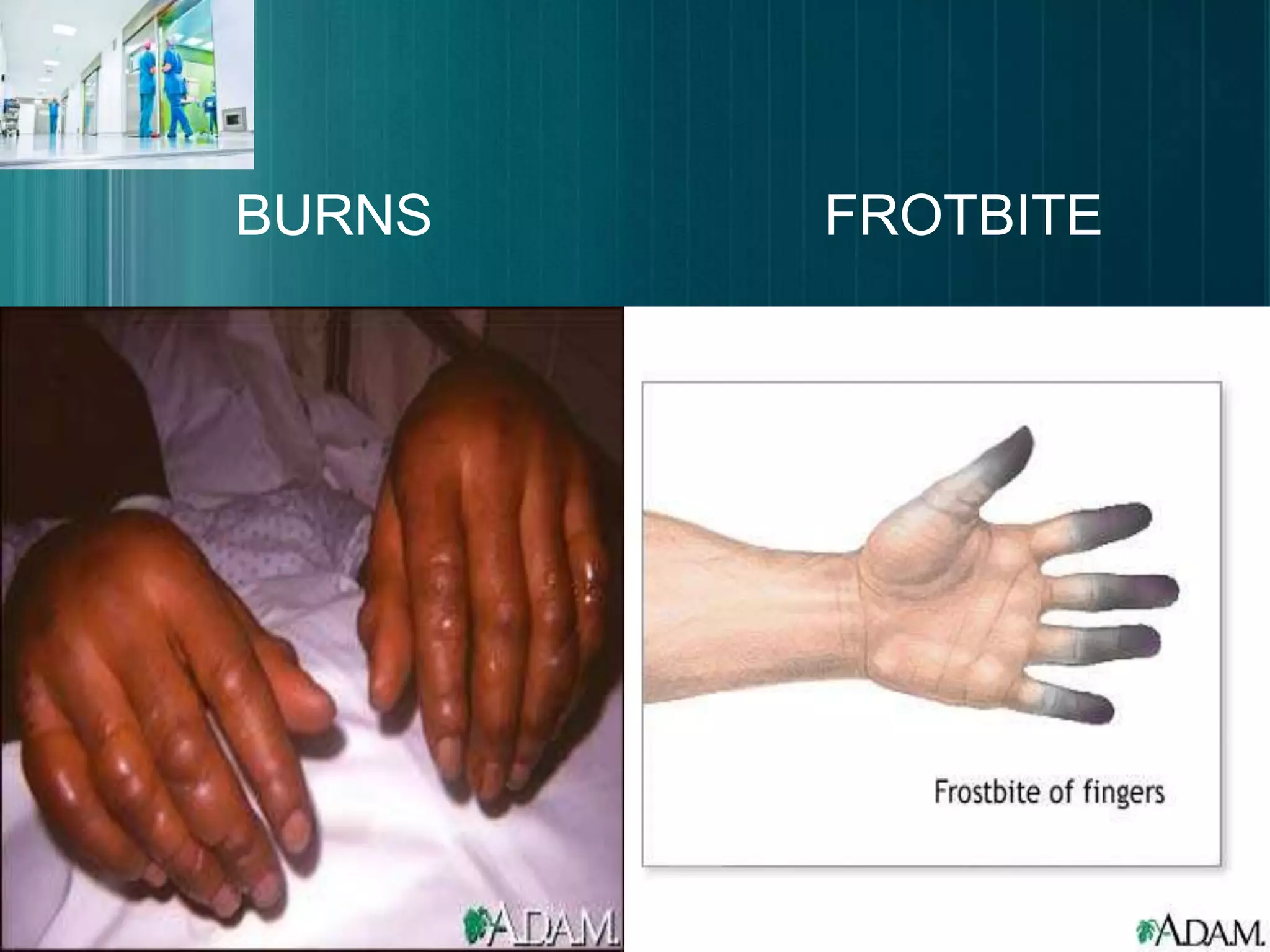 Amputation,Stump care, phantom limb pain and gait training in lower ...