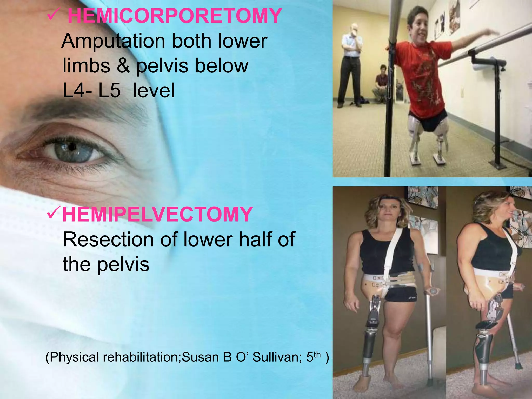 Amputation,Stump care, phantom limb pain and gait training in lower limb | PPTX