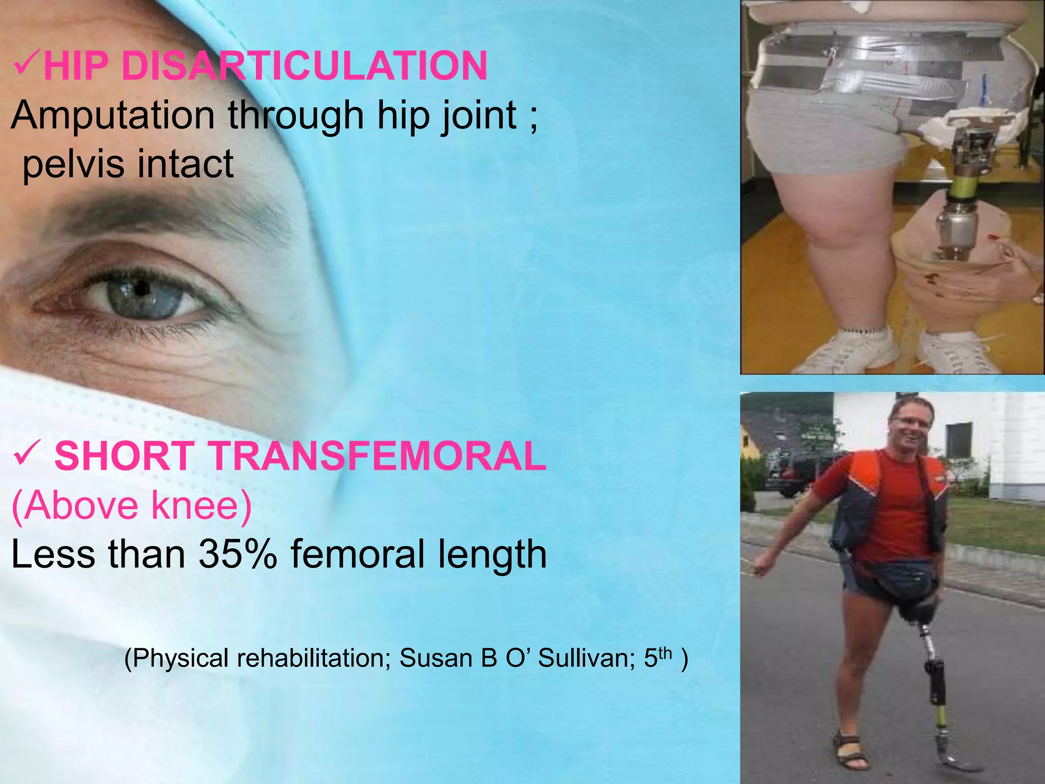 Amputation,Stump care, phantom limb pain and gait training in lower limb | PPTX