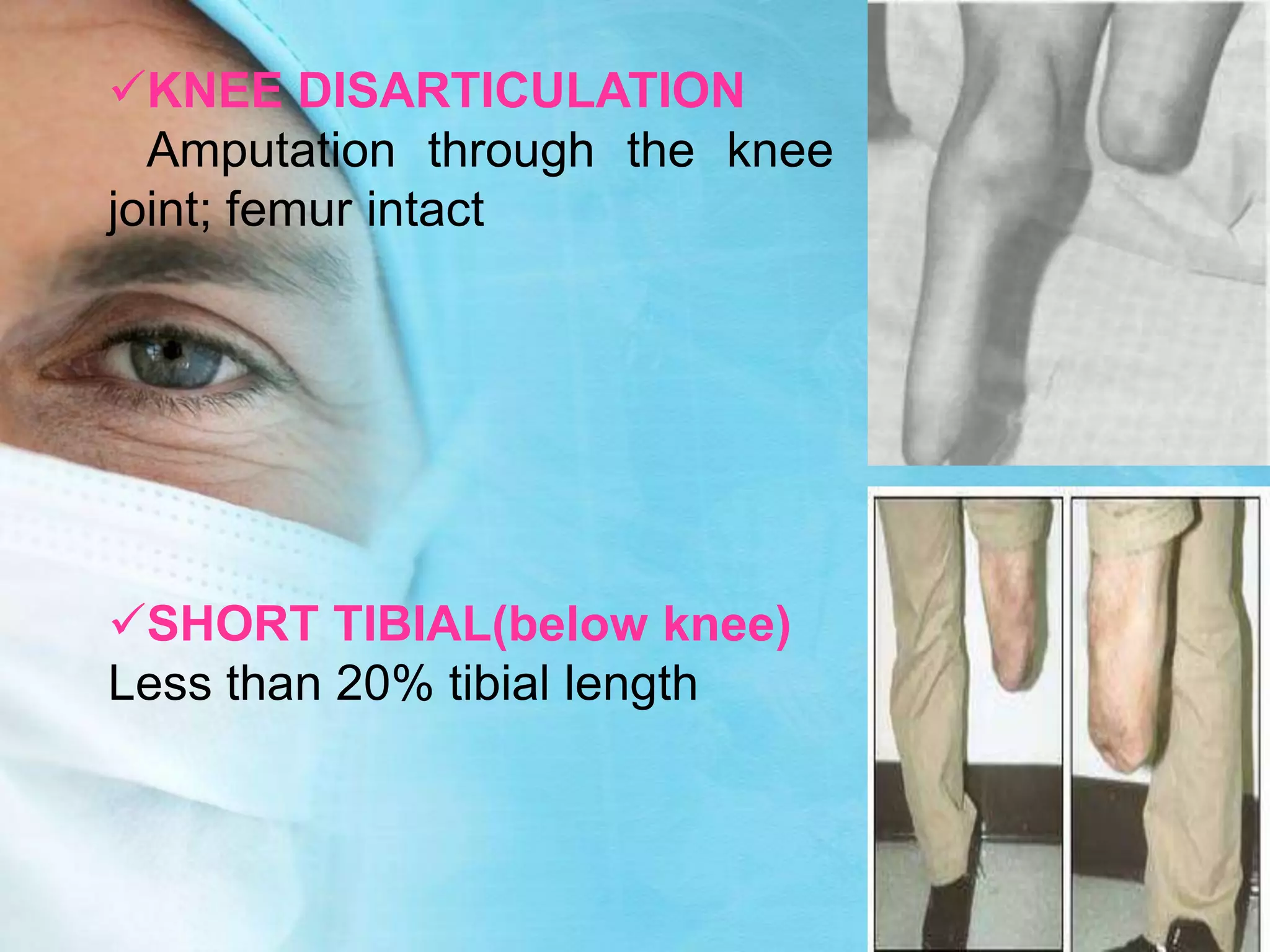 Amputation,Stump care, phantom limb pain and gait training in lower ...